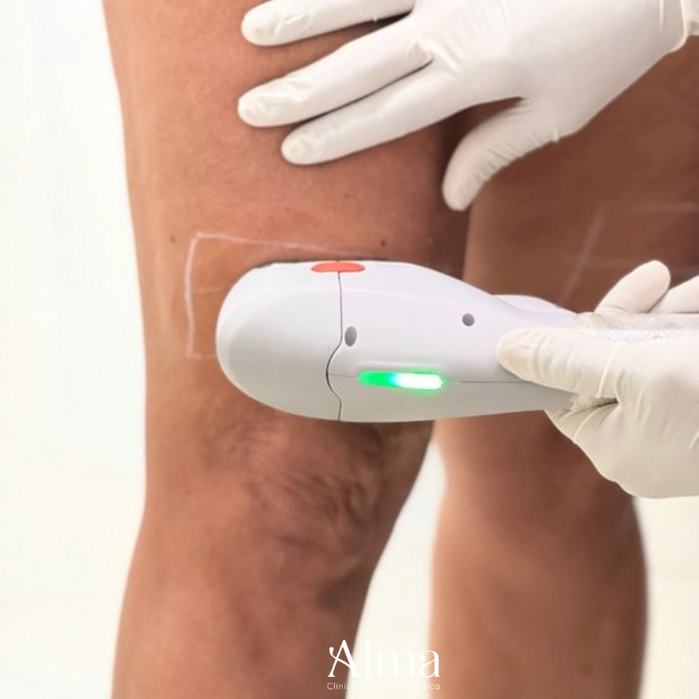 HIFU Corporal 1 sesión (zona S) – Clínica Medicina Estética Alma